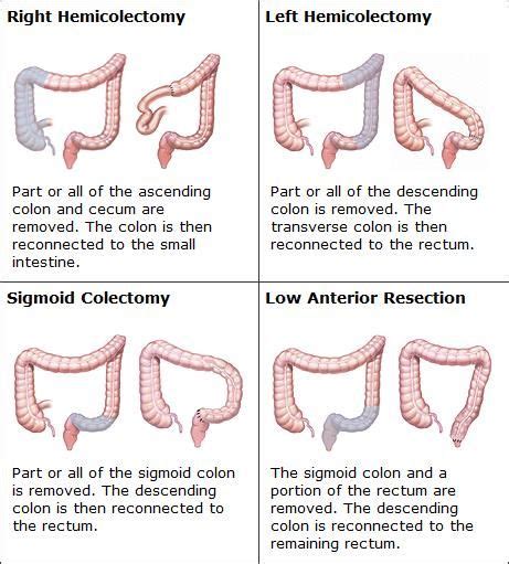 How Long Does A Left Hemicolectomy Take John Wade Bruidstaart