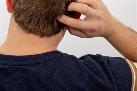 鬼剃頭前兆：3大警訊、5個斑禿成因圓形禿治療指南 Perfect Hair