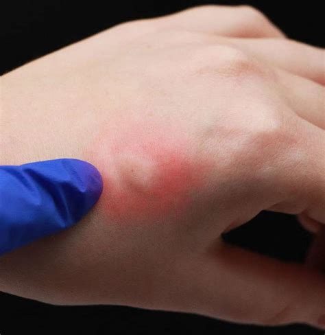 Red Ant Bite Allergic Reaction