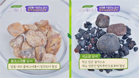 콜레스테롤 담석and색소성 담석이 생기는 원인 Zum Tv