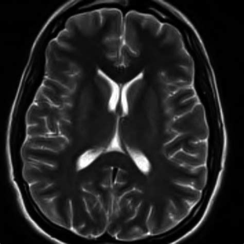 CT Head 5 D Postanoxic Brain Injury With Low Attenuation In Bilateral Download Scientific