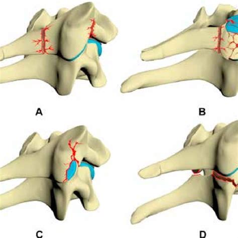 Variants Of Traumatic Injury Of Lateral Masses According To Y Kotani