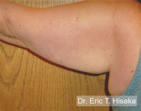 Arm Reduction By Dr Hisaka Pleasanton Brachioplasty