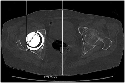 Direct Anatomic Registration In Computer Assisted Total Hip Arthroplasty Improves Accuracy Of