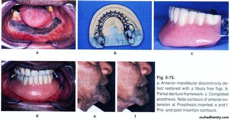 Acquired Mandibular Defect Pptx Drmunia Muhadharaty