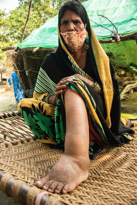 Lymphatic Filariasis Elephantiasis 40 Off