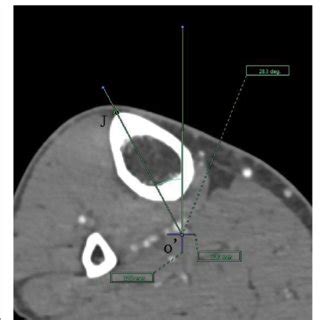 Anterior Tibial Crest Axis Was Drawn As A Line Passing Through The Download Scientific Diagram
