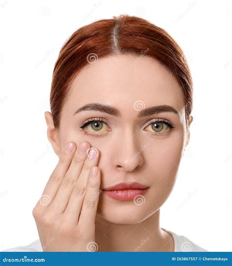 Woman With Yellow Eyes On White Background Symptom Of Hepatitis Stock