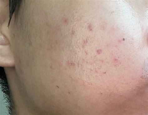 피부 고민입니다 붉은기 지식in