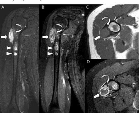 Figure 4 From Classification Of Chondrosarcoma From Characteristic To Challenging Imaging