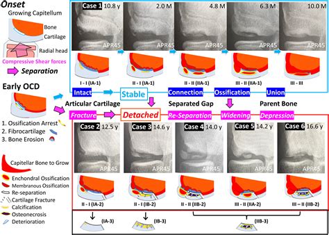 Osteochondritis Dissecans Of The Elbow Recent Evolution Of