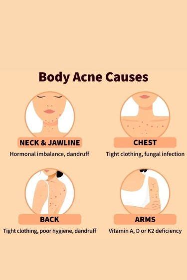 Body Acne Causes Acne Skincare Acne Causes Skin Care Acne Skin Care