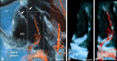 Communication Of Subarachnoid Spaces With Virchowrobin Spaces Vrs In