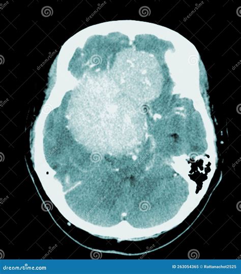 Ct Brain Axial Scans Hyperdense Mass With Homogeneous And Mild