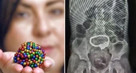 Bambino Col Mal Di Pancia Da Mesi Si Scopre Che Ha 52 Palline Di