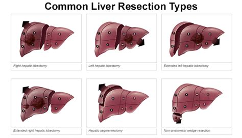Surgery Fibrolamellar Cancer Foundation