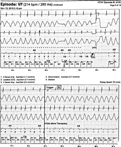Polymorphic Ventricular Tachycardia Vs Ventricular Fibrillation