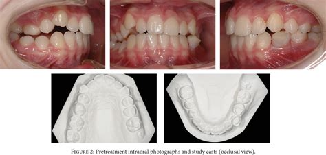 Figure 2 From Unilateral Maxillary First Molar Extraction In Class Ii
