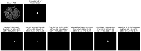 Transfer Learning Approaches For Brain Metastases Screenings
