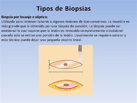Toma De Biopsia Y Manejo De La Muestra