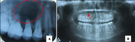 Figure 2 From Mural Ameloblastoma A Case Report Semantic Scholar