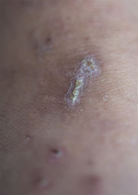 Scars On The Skin That Scab People Stock Image Image Of Flesh
