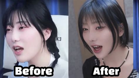 코성형 결국 해버린 나 👃🏻🤧코수술브이로그 Youtube