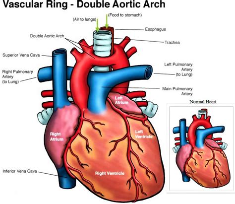 Vascular Ring Causes Symptoms Diagnosis Treatment And Prognosis