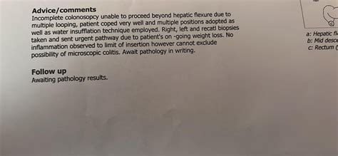 Multiple Loops And Incomplete Colonoscopy Rulcerativecolitis