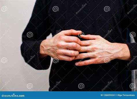 Man Scratch Oneself Dry Flaky Skin On Hand With Psoriasis Vulgaris