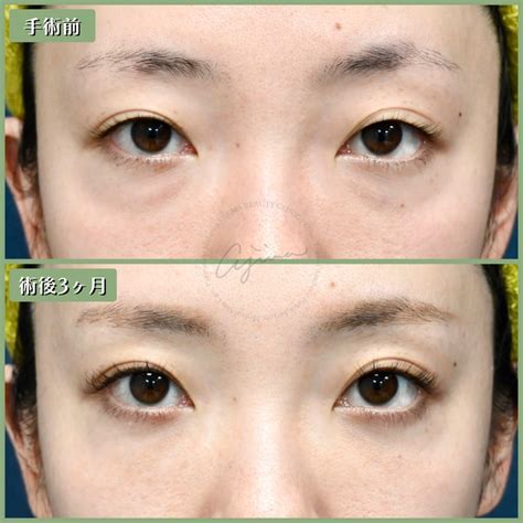 クマの治療は膨らみ取りだけではない！凹みも治して滑らかに！ 美容外科医・dr安嶋“あじ先生”のブログ『あじブロ』