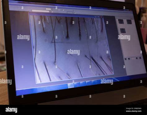 Compute Screen With Trichoscopy Diagnosing Of Hair Scalp Evaluation Diseases Closeup Hair