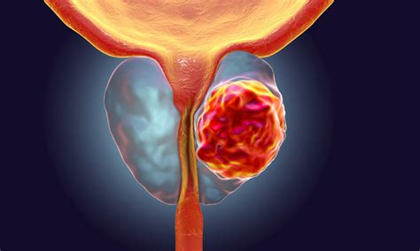 Greb1 Gene Potential Drug Target For Prostate Cancer Treatment