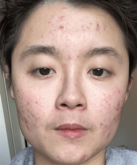 Mdacne Get Clear Skin With A Custom Acne Treatment