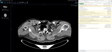 Mpr Of 3000 Slice Images Allocation Error · Issue 1438 · Ohifviewers
