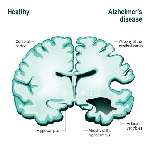 People With Alzheimer Disease Have A Deficiency In Which Neurotransmitter