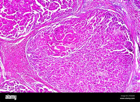 Human Liver With Metastatic Carcinoma Optical Microscope X40 Stock