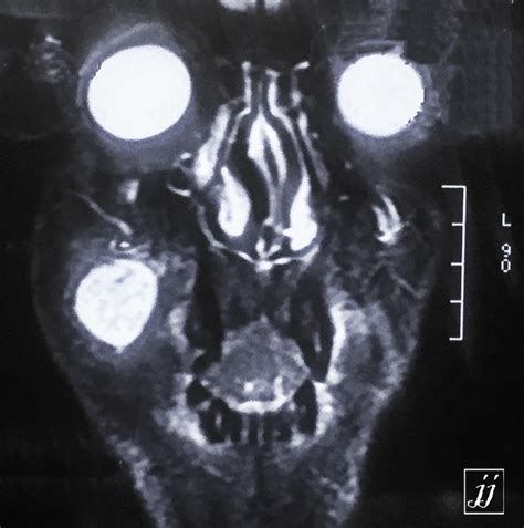 Orbit Right Maxillary Sinus Retention Cyst Radioogle