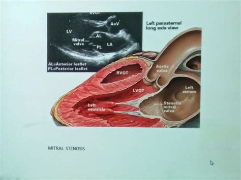 Lecture Slides Cardiology Mitral Stenosis