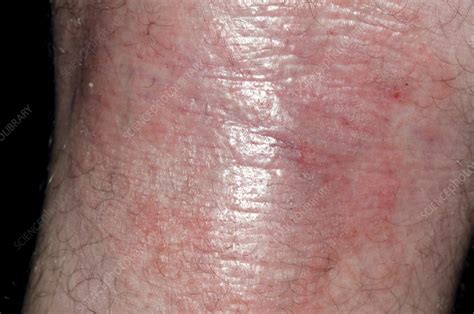 Eczema Behind Knees And On Legs 7 Year Old With Eczema