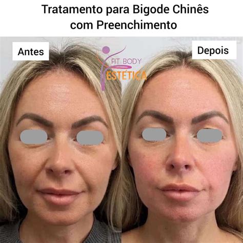 Tratamento Para Bigode Chinês Com Preenchimento Dra Sacha