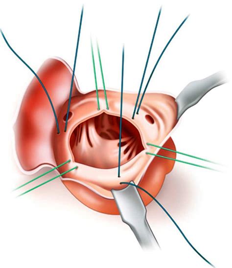 Schematic 3 Stay Sutures Are Placed As Shown In The