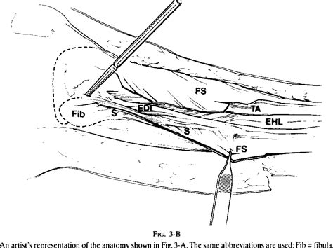 Figure 3 From Ganglion Cyst Of The Proximal Tibiofibular Joint Causing