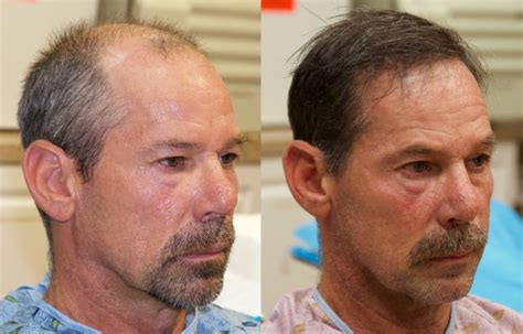 Frontal Scalp Hair Restoration Grafts Carolina Hair Surgery