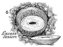 Conization Of The Cervix By The Loop Electrical Excision Procedure LEEP
