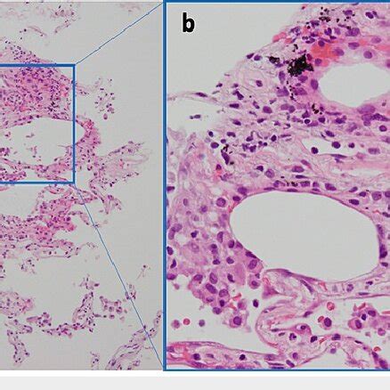 Histological Examination Of Transbronchial Lung Biopsy A Hematoxylin