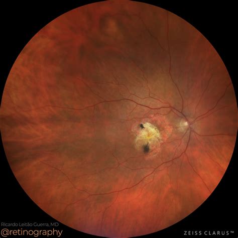 Amd Disciform Scar Retinography
