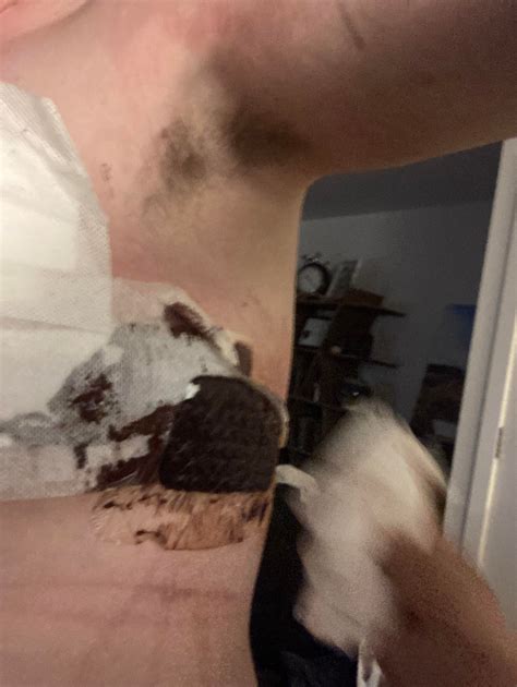 Scary Hematoma Experience R Topsurgery