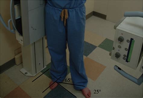 Hip Radiographic Evaluation Adult Recon Orthobullets