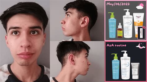 Beforeandafter My 15 Year Skincare Journey The Battle Against Acne